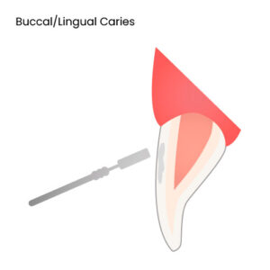 CurodontTM Repair - vVARDIS Switzerland - Biomimetic Dental Science