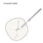 CurodontTM Repair - vVARDIS Switzerland - Biomimetic Dental Science